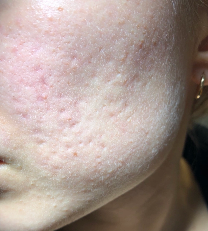 Yleistä aknesta ja hoitovaihtoehdoista – Marika Schröder